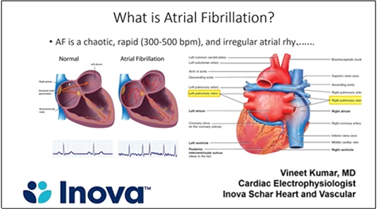 Inova AFib Center | Inova